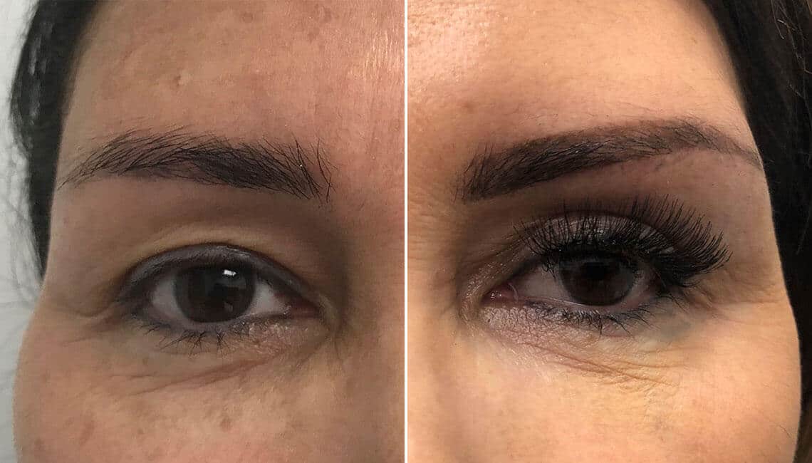 Blepharoplasty Eyelid Surgery in Miami | Plastic Surgeon Dr. Gallo